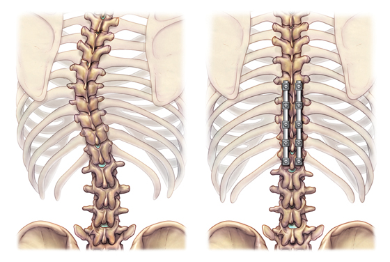 Scoliosis correction surgery (fixation by screws)