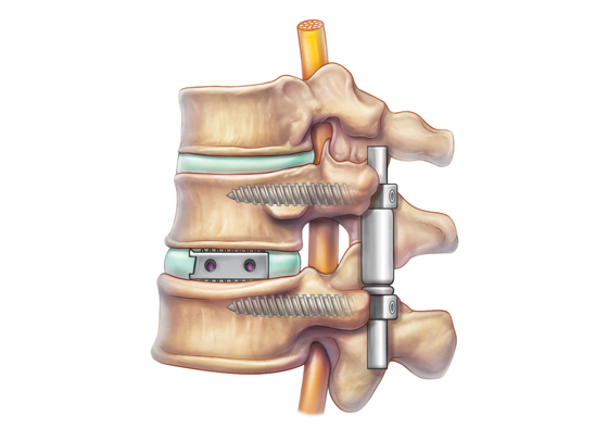 Anterior Lumbar Interbody Fusion